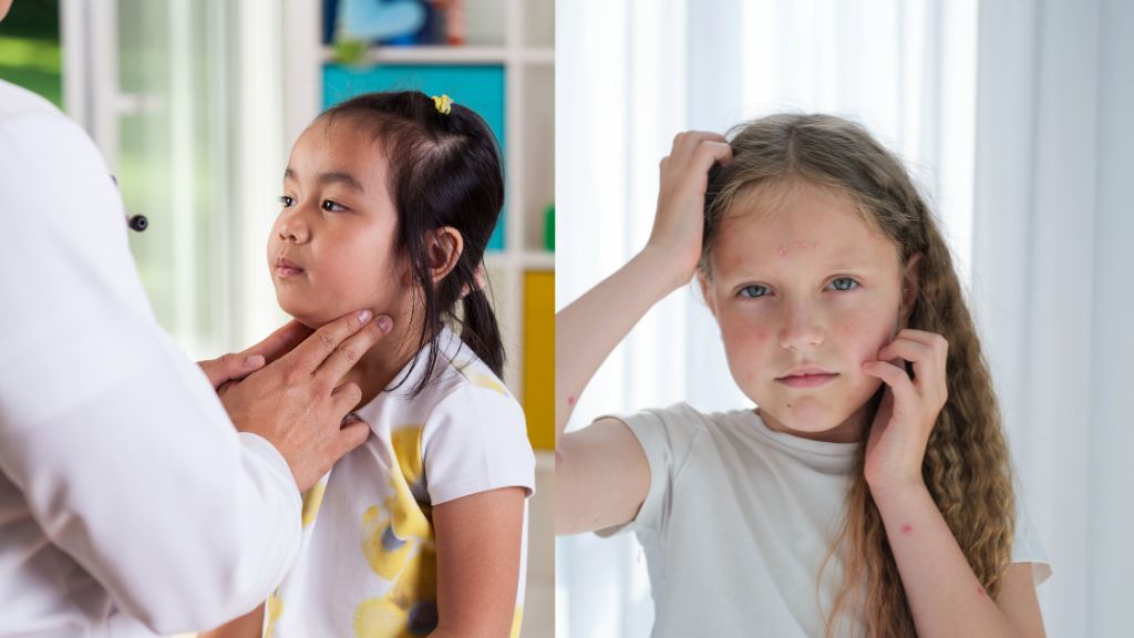 Điều cần biết về quai bị và thủy đậu, phân biệt chúng ra sao? - Nhà ...