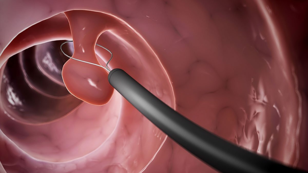 Cắt polyp dạ dày là gì và những điều mà bạn cần biết