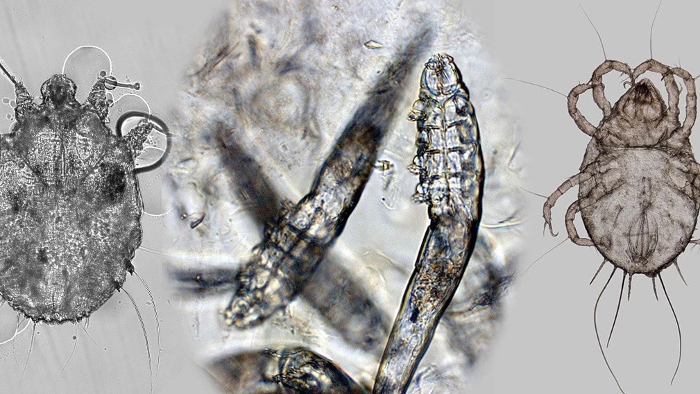 Xét nghiệm Demodex soi tươi có ý nghĩa gì? Cách đọc kết quả