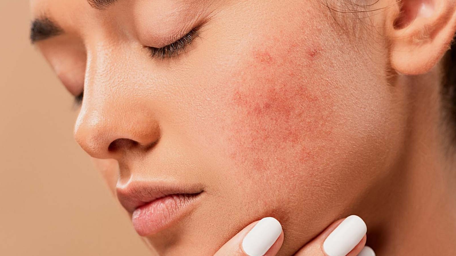 Eryne gel là gì? Công dụng và hướng dẫn sử dụng Eryne gel