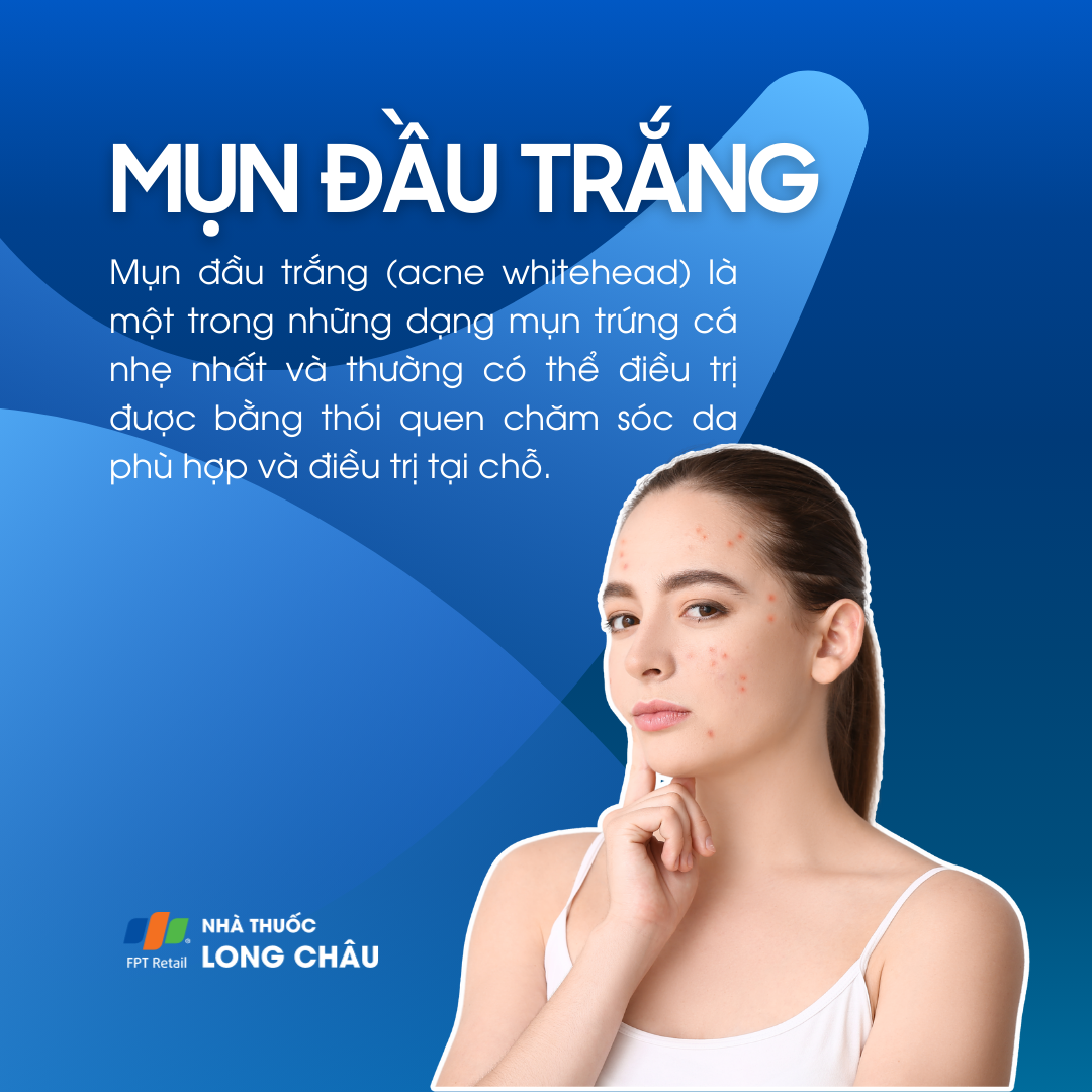 Mụn đầu trắng: Nguyên nhân và cách trị mụn tận gốc