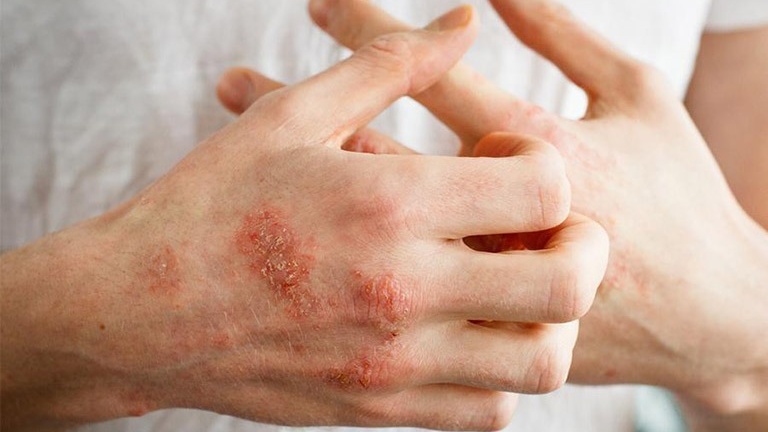 Nấm da Tinea là gì? Nguyên nhân và triệu chứng nấm da Tinea
