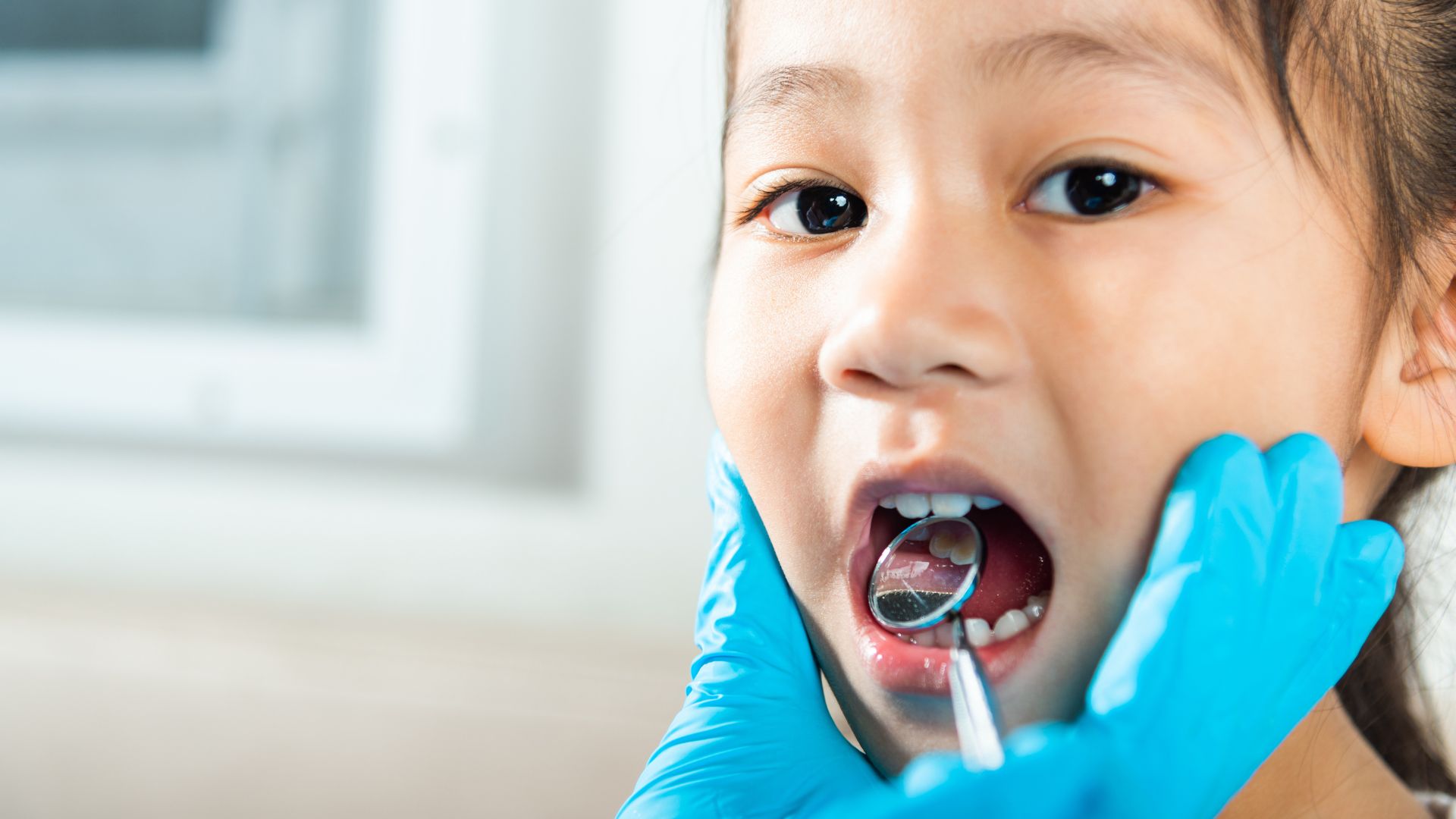Em bé bị sâu răng sữa nên làm gì? Cách phòng ngừa sâu răng sữa