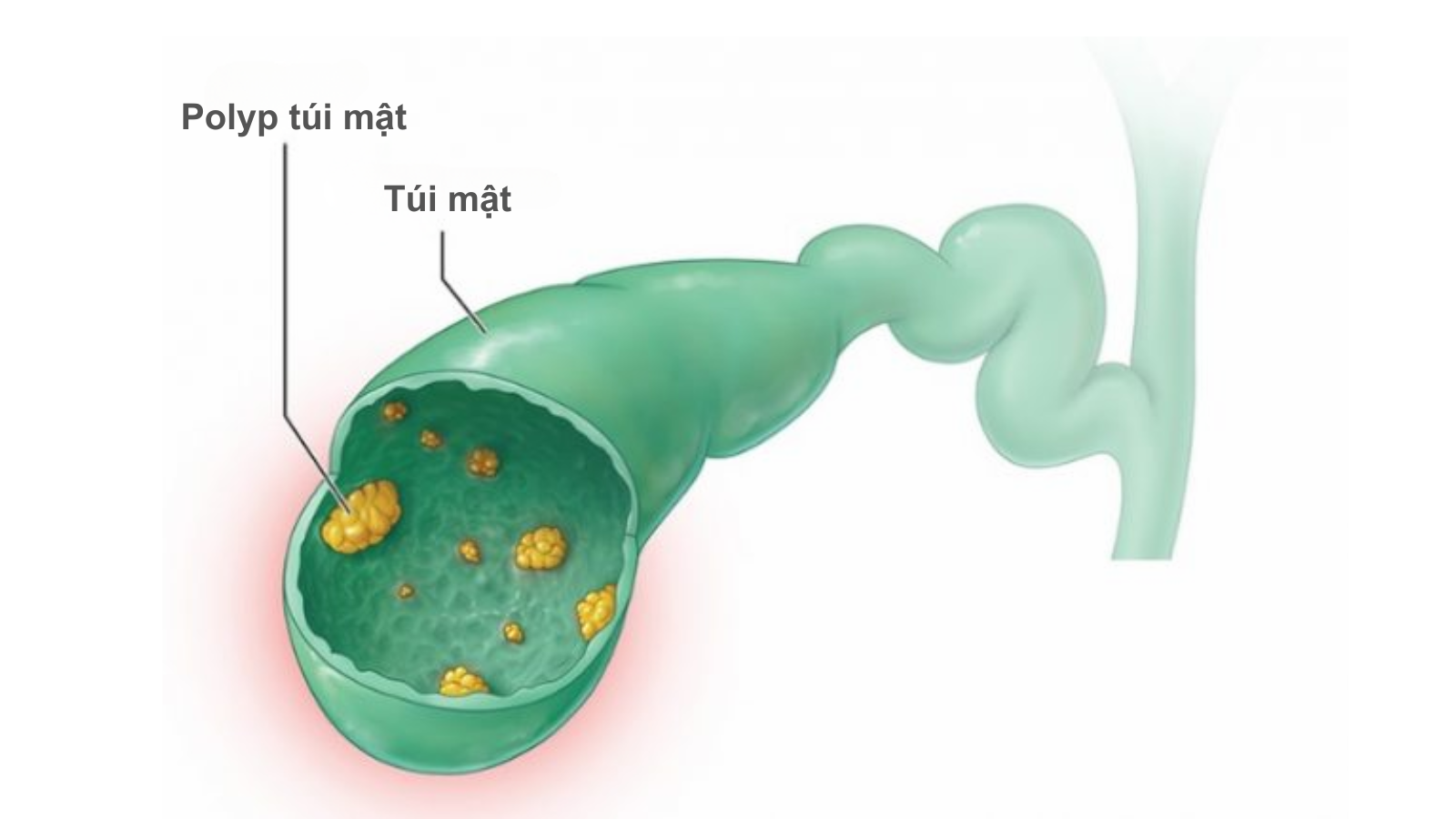 Polyp túi mật 6mm có nguy hiểm không? - Long Châu