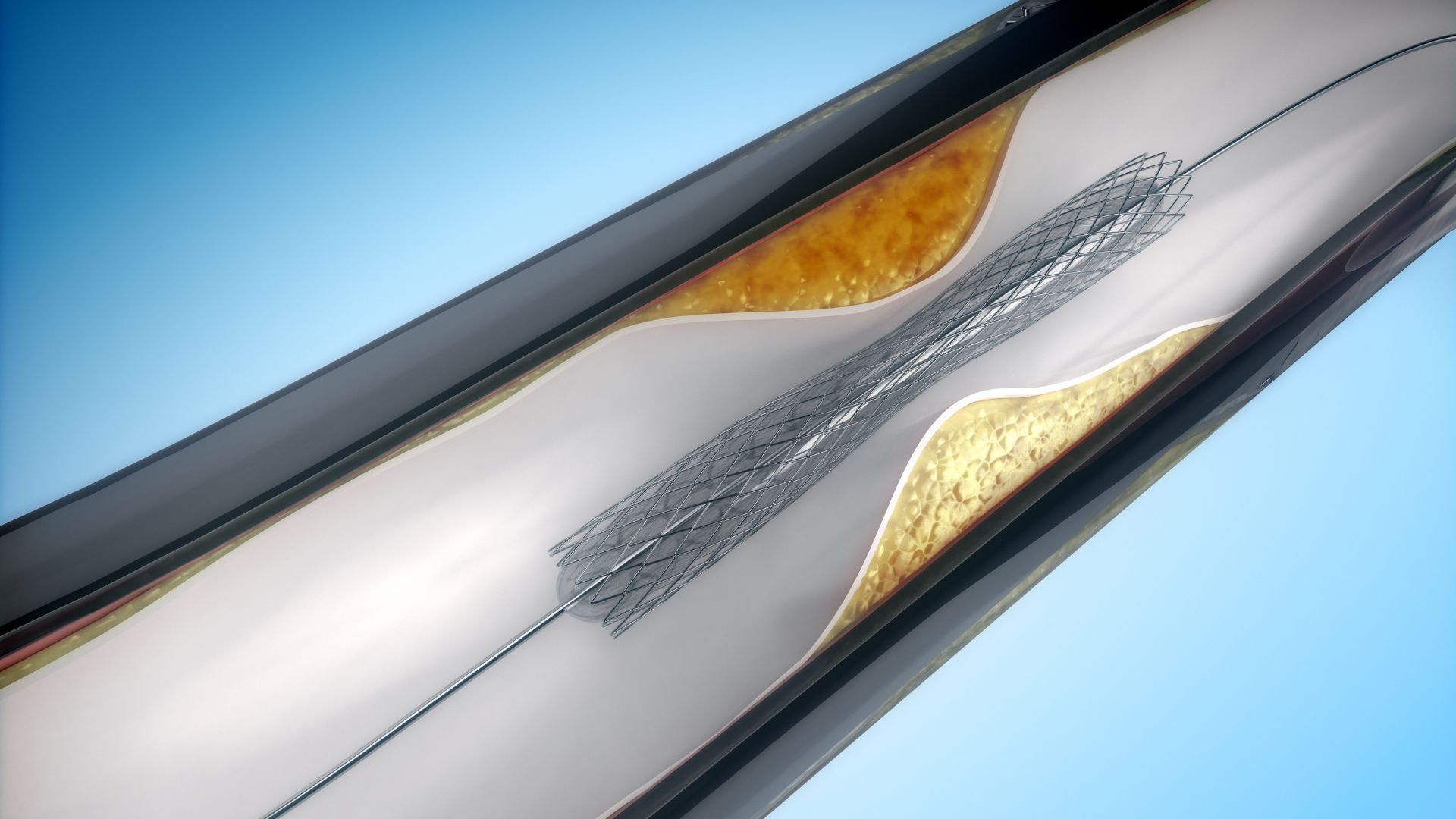 Stent là gì ? Những lợi ích mà stent mang lại cho y học