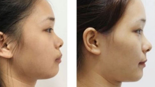 Giải đáp: Tập Mewing có cải thiện mặt lệch không? - Nhà thuốc FPT Long Châu