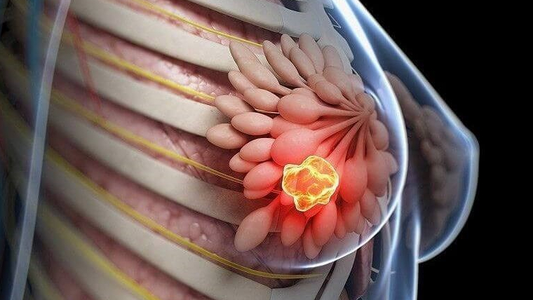 Những điều cần biết về ung thư biểu mô tiểu thuỳ tại chỗ
