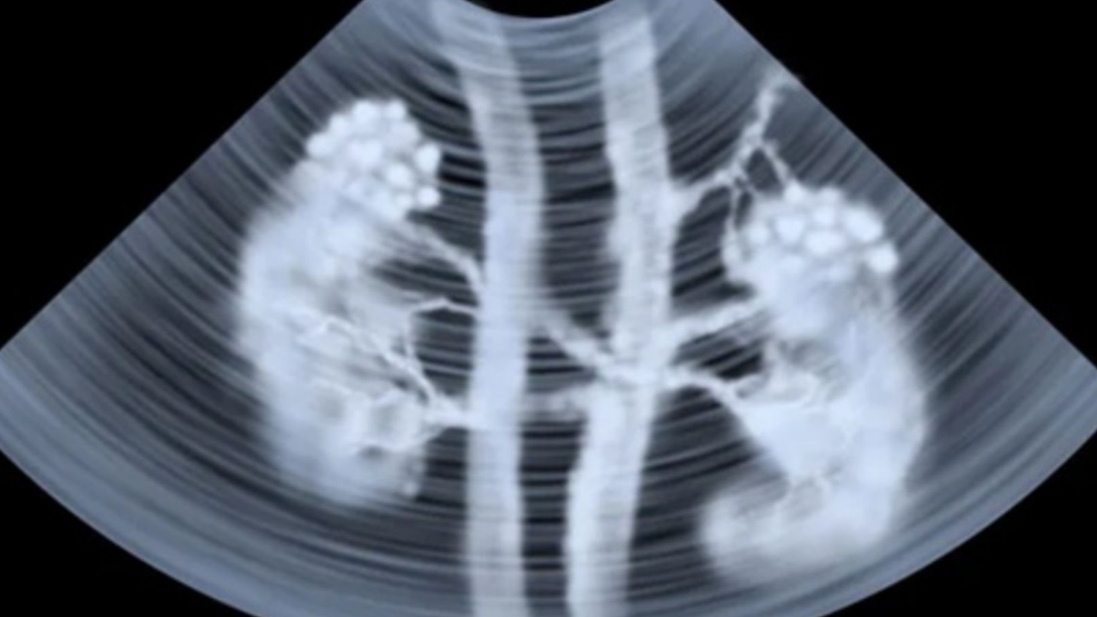 Xạ hình thận: Đối tượng được chỉ định và quy trình chụp chiếu